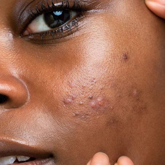 COMMENT RÉDUIRE LES TACHES D'ACNÉ ? – TRUE The Argan Company